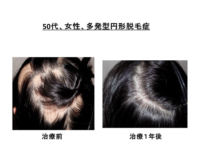 皮膚科治療の脱毛薬で悪化した円形脱毛症、治療1年で、明らかな改善！ 患者様からの声・メディア掲載・クリニックからのお知らせ 名古屋kクリニック
